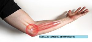 Golfalbue (medial epikondylitt) | Råholt Kiropraktorsenter & Fysioterapi