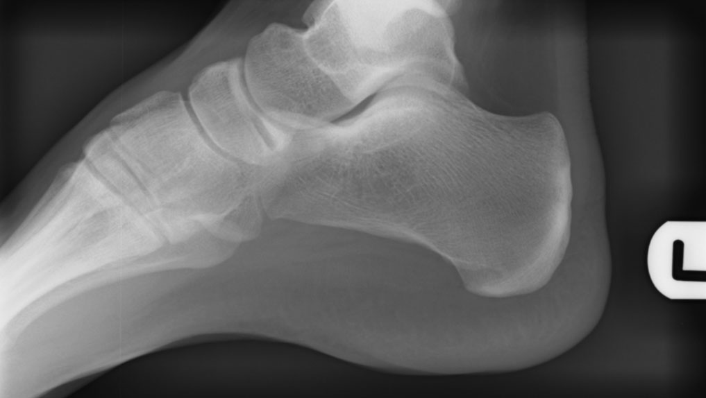 Haglunds hæl | Råholt Kiropraktorsenter & Fysioterapi (Eidsvoll kommune)